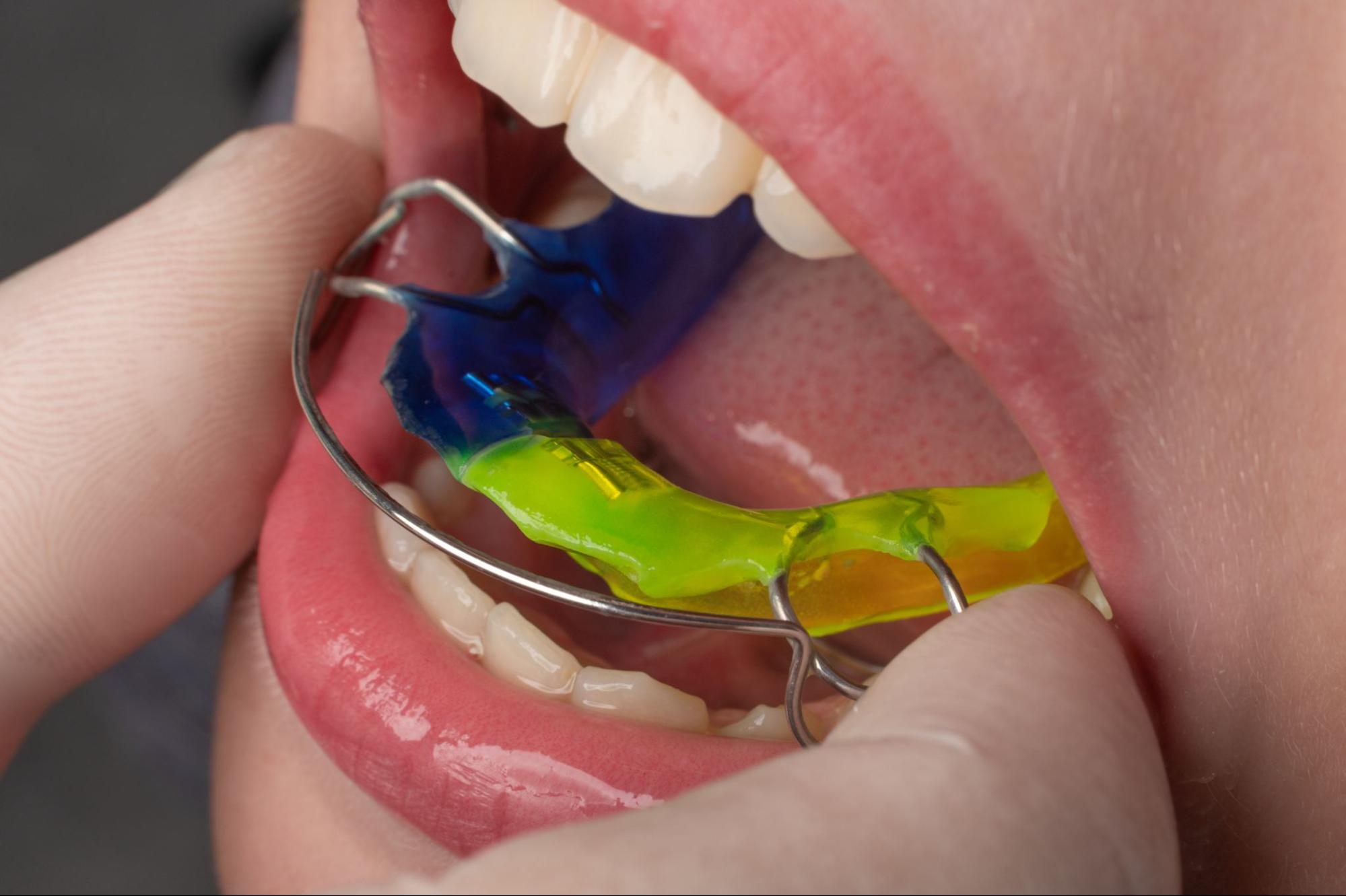 Why Choose Fixed Retainers | Ollins Orthodontics