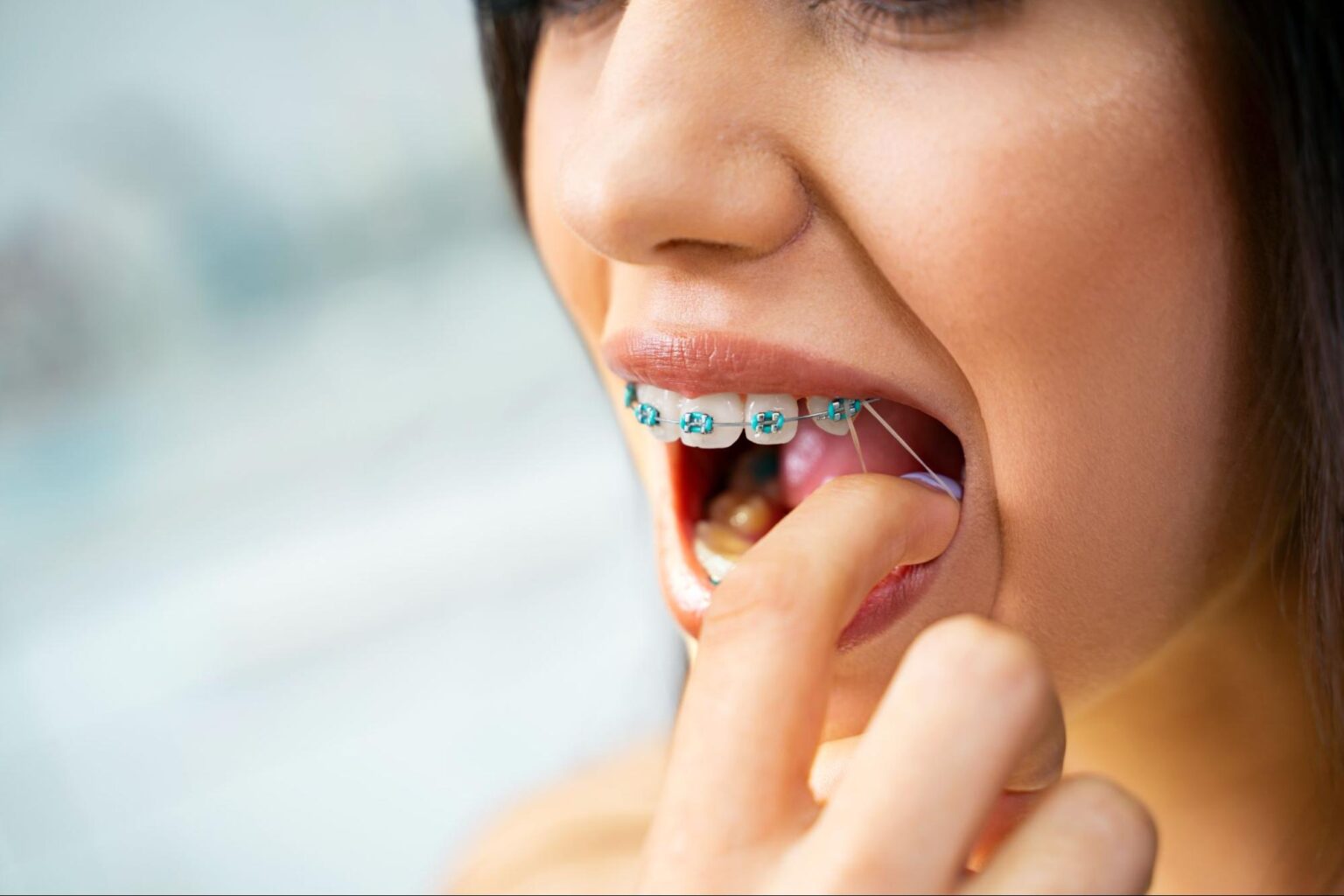 What Is the Role of Rubber Bands in Braces Treatment? | Ollins Orthodontics